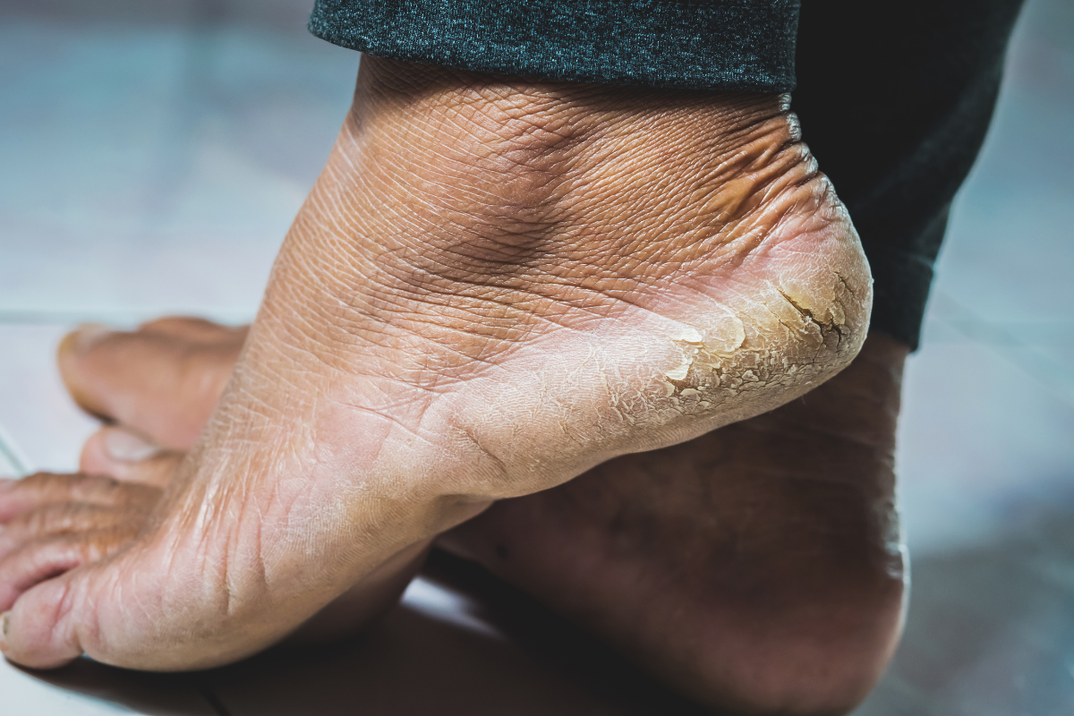 Podiatry Skin Treatments For The Feet | PhysioCentral